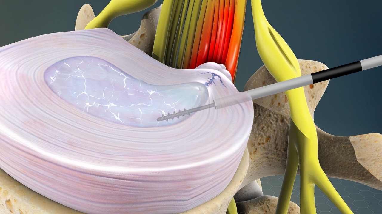 Cirugías de columna: la discectomía - Neurocirugía de la Torre